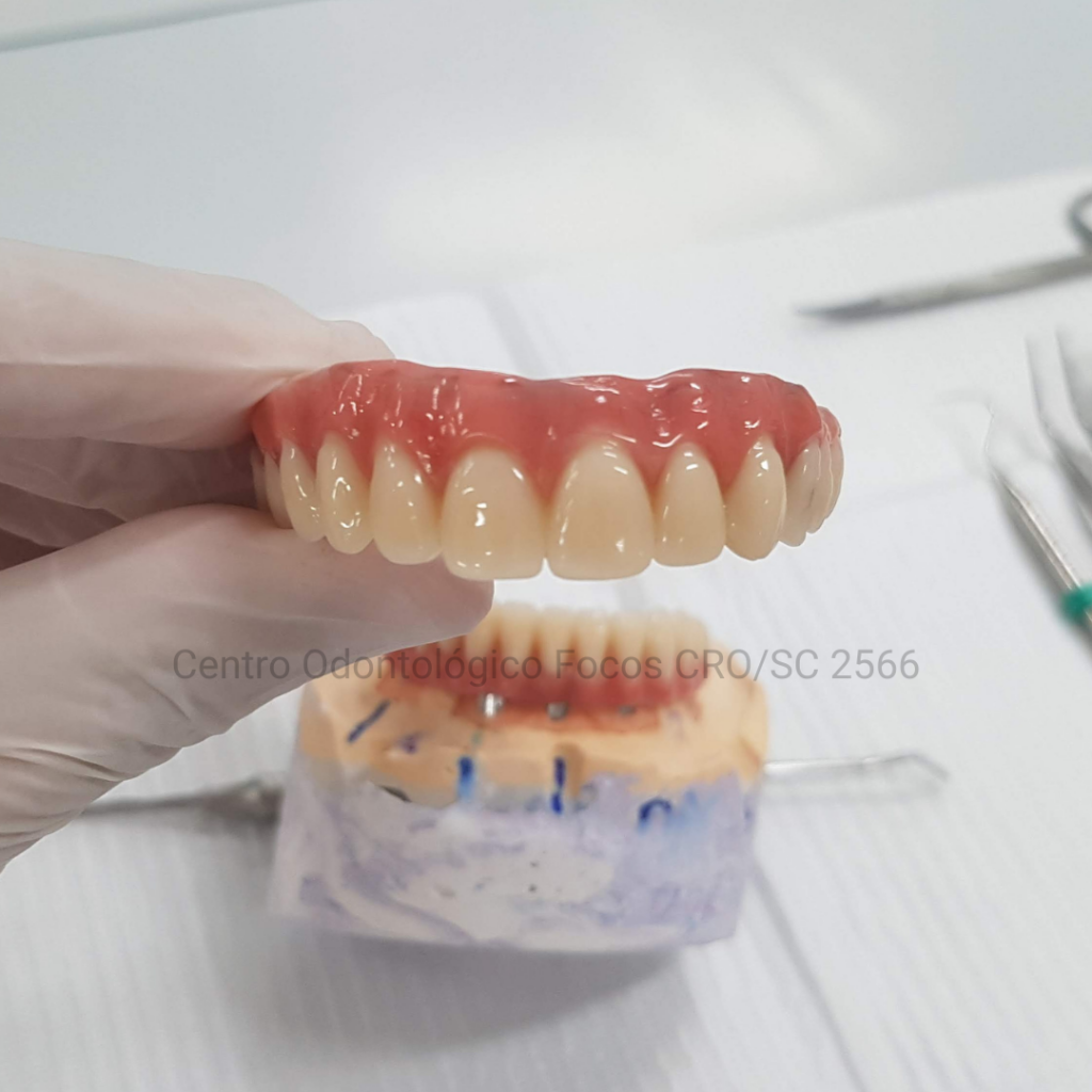 Clínica especializada em Prótese Protocolo em Florianópolis